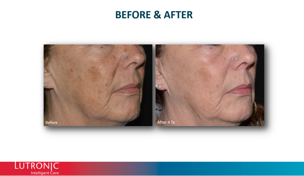 LaseMD Ultra - ENT Aesthetics